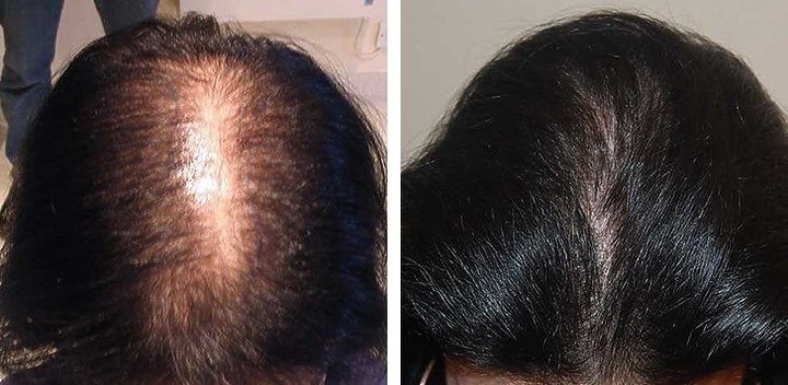 Permanent Hair Restoration for Women: How Does it Work?
