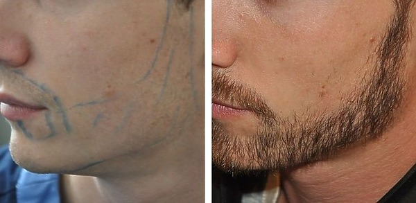 Beard Transplant Timeline: Recovery, Risks and Results