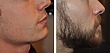 Beard Transplant Timeline: Recovery, Risks and Results