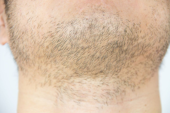 Fixing Beard Bald Spots From Alopecia Barbae & Other Causes