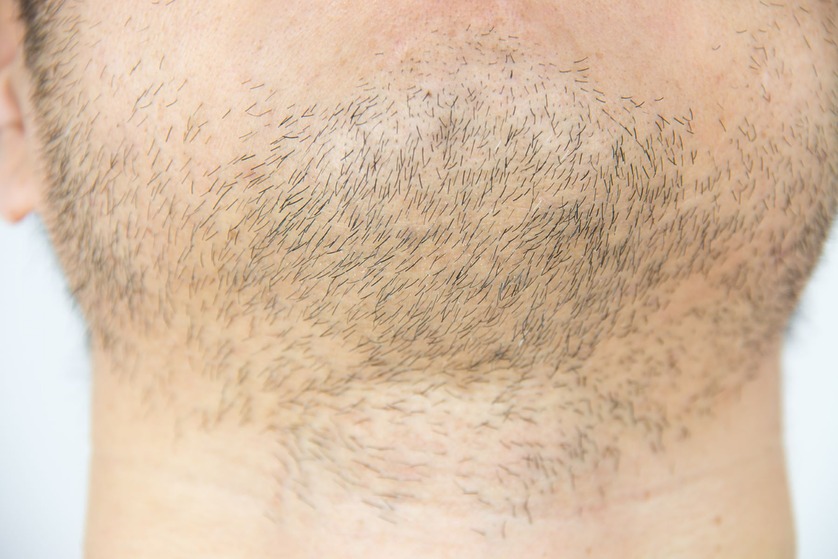 Fixing Beard Bald Spots From Alopecia Barbae And Other Causes