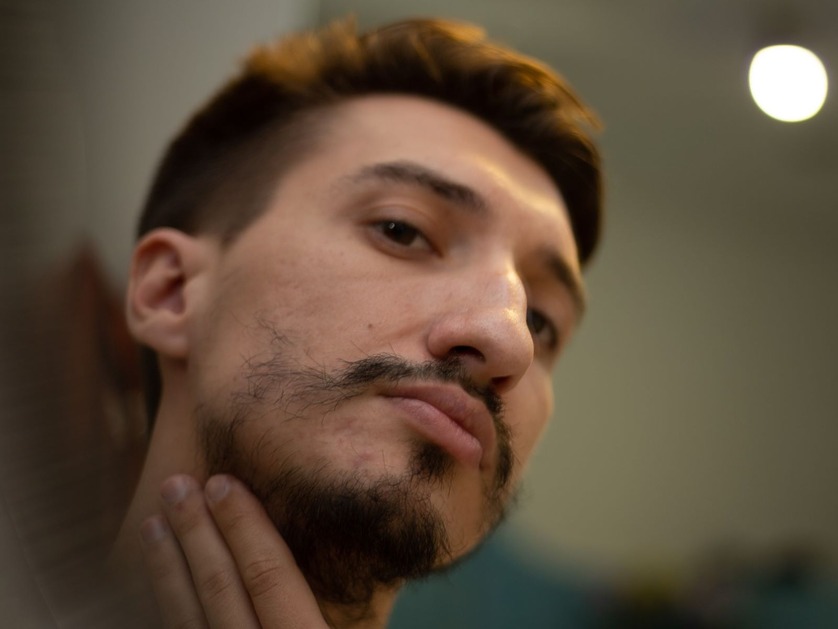 Fixing Beard Bald Spots From Alopecia Barbae & Other Causes