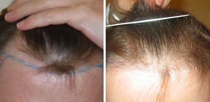 Male-To-Female MTF Hair Transplant: Costs, Photos, Eligibility