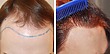 Male-To-Female MTF Hair Transplant: Costs, Photos, Eligibility