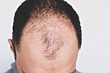 10 Ways To Deal With A Bad Receding Hairline - Wimpole Clinic