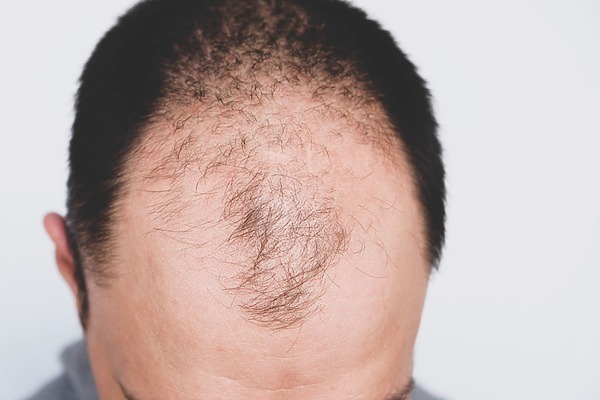 10 Ways To Deal With A Bad Receding Hairline - Wimpole Clinic