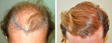 Does Radiotherapy Cause Hair Loss (And Can You Prevent It)?