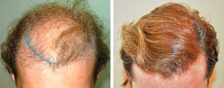 Does Radiotherapy Cause Hair Loss (And Can You Prevent It)?