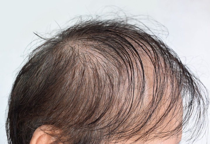 Diffuse Unpatterned Alopecia: Causes, Symptoms, Treatment