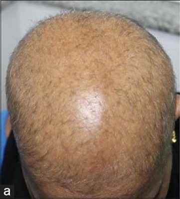 Diffuse Unpatterned Alopecia: Causes, Symptoms, Treatment