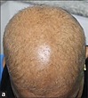 Diffuse Unpatterned Alopecia: Causes, Symptoms, Treatment