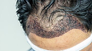 When Can I Rub My Head After a Hair Transplant? A Full Guide