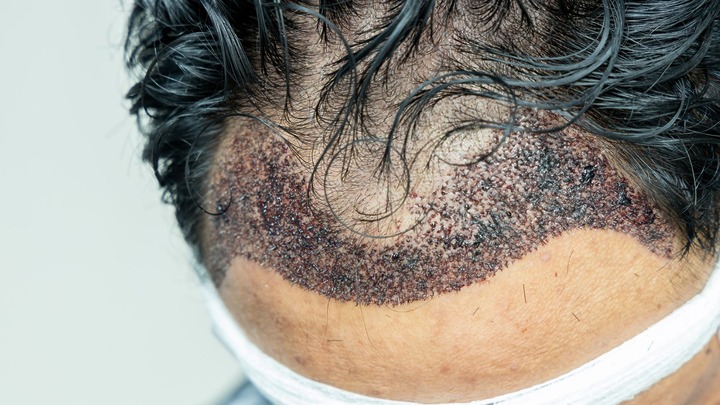 When Can I Rub My Head After a Hair Transplant? A Full Guide