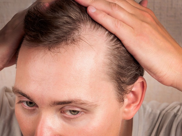 What Is Hair Miniaturisation And How Can You Reverse It?