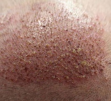 Follicular Eczema: Causes, Symptoms, Treatment
