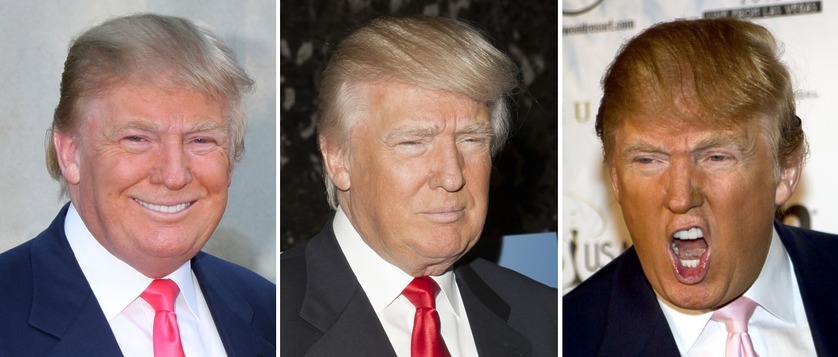 Donald Trump’s Hair: Did He Have a Hair Transplant?