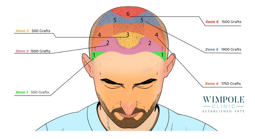 Joe Rogan’s Hair Transplant: Where Did Things Go Wrong?