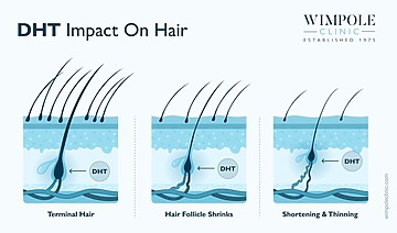 DHT Creams For Hair Growth: Do They Work? - Wimpole Clinic