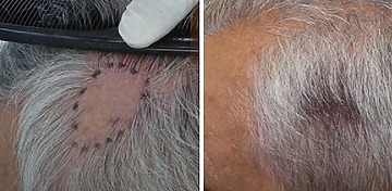 Temporal Triangular Alopecia: Causes, Symptoms and Treatment