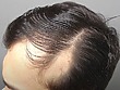 Temporal Triangular Alopecia: Causes, Symptoms and Treatment