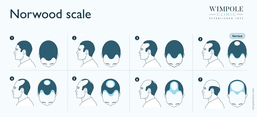 Hair Implants For Men: Procedure, Results, Costs & Recovery