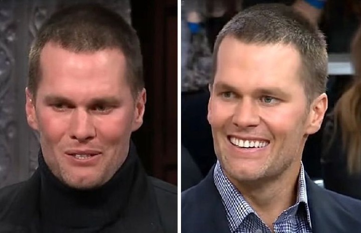 Tom Brady’s Hair Transplant: Did It Really Happen?