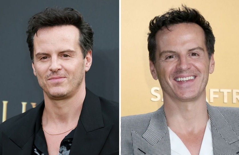 Andrew Scott’s Hair Transplant - Did It Really Happen?
