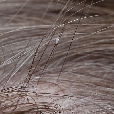 Recurring Scab On Scalp In The Same Spot: How to Treat