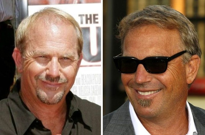 Kevin Costner’s Hair Transplant: Everything You Need to Know
