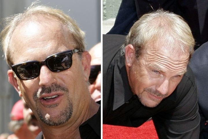 Kevin Costner’s Hair Transplant: Everything You Need to Know