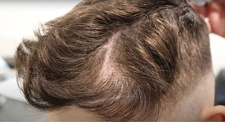 Jake Quickenden’s Hair Transplant: All the Details