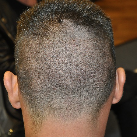 FUE Hair Transplants: Procedure, Results, Recovery and Costs
