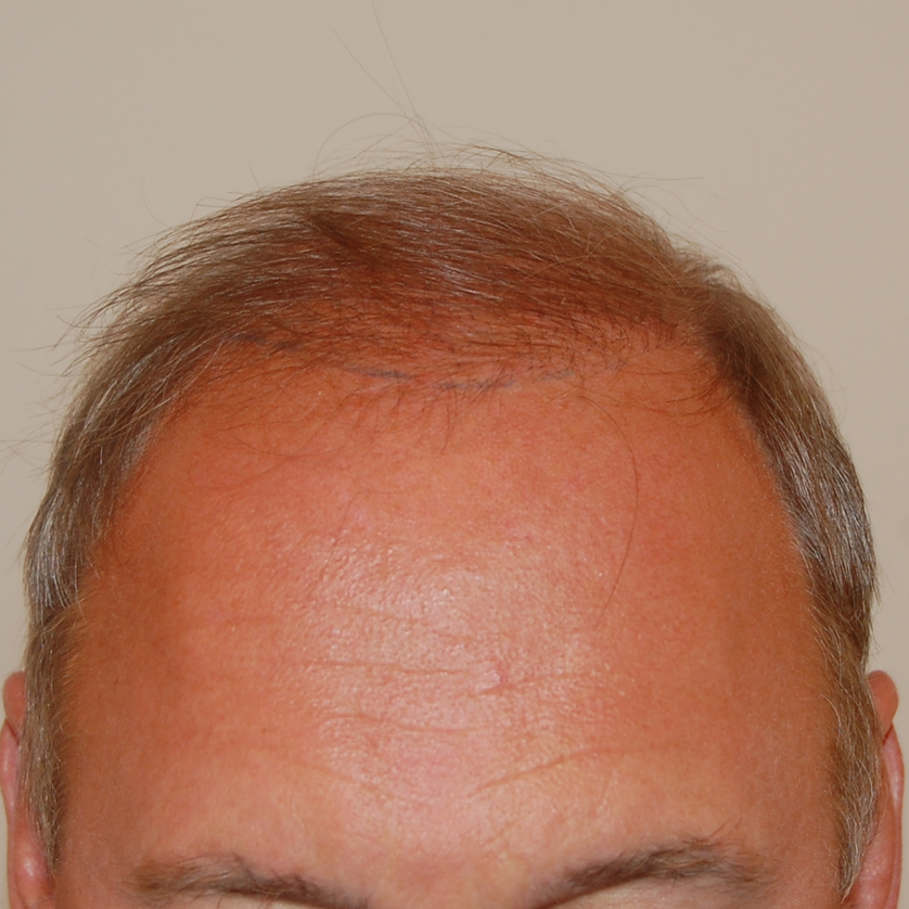 1000 Graft Hair Transplant: Coverage, Costs, Results