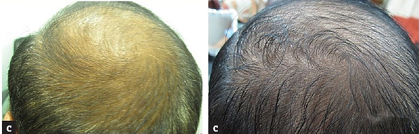 Derma Roller For Hair Growth: Expert Review 2025 - Wimpole Clinic