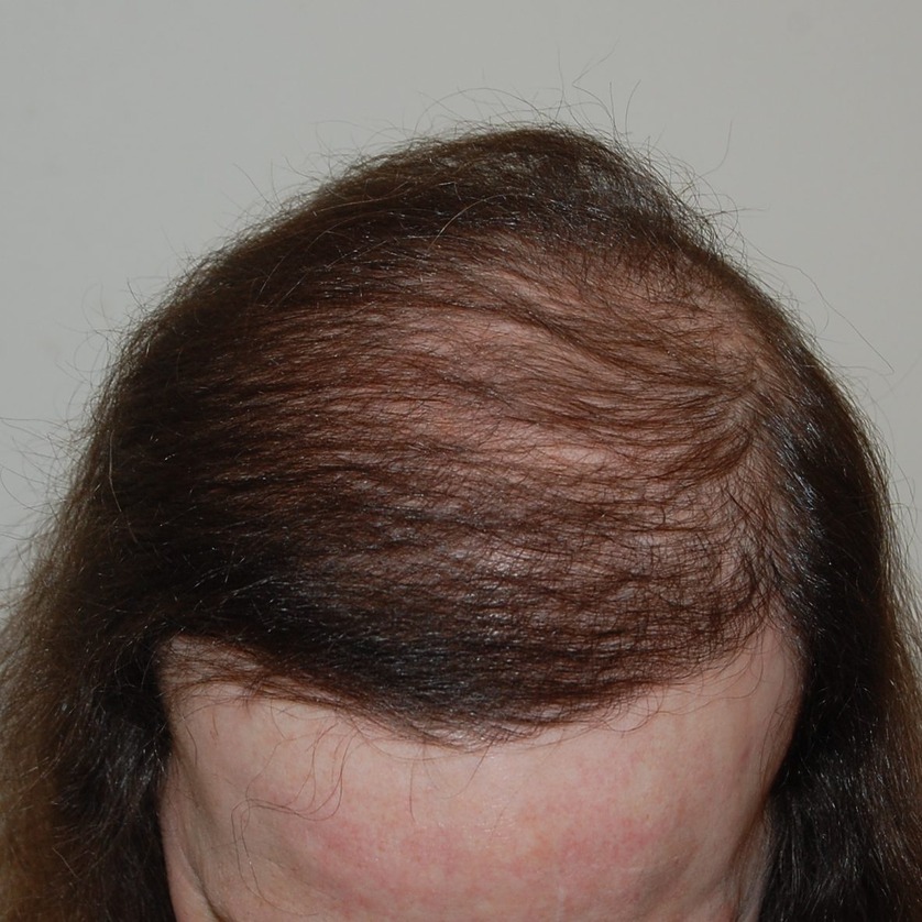 5000 Graft Hair Transplant: Coverage, Costs, Results