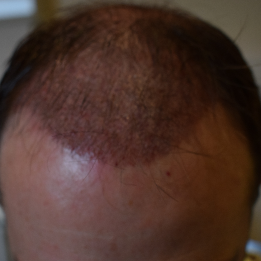 Hair Transplant After 1 Month: Photos, Results, Side Effects