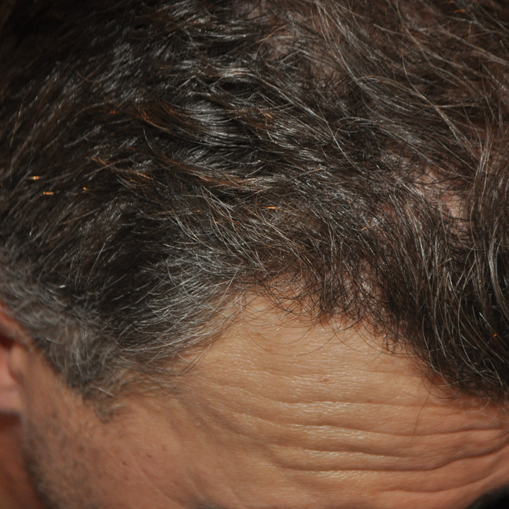 Norwood Stage 2: Photos, Treatments, Results | Wimpole Clinic