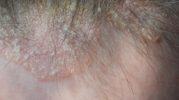 12 Reasons Your Scalp Itches A Day After Washing And How To Treat Them