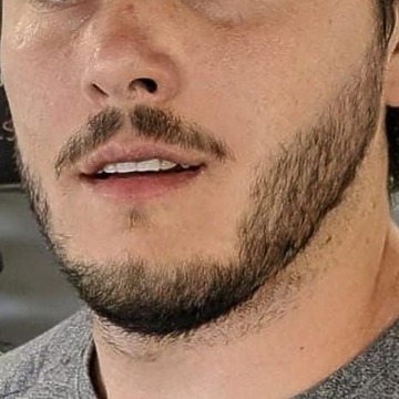 How To Fix Beard Bald Spots | Wimpole Clinic