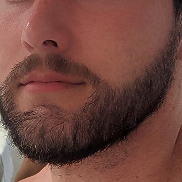 How To Fix Beard Bald Spots | Wimpole Clinic