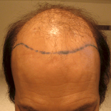 Completely Bald Hair Transplant: Can It Be Done? | Wimpole Clinic