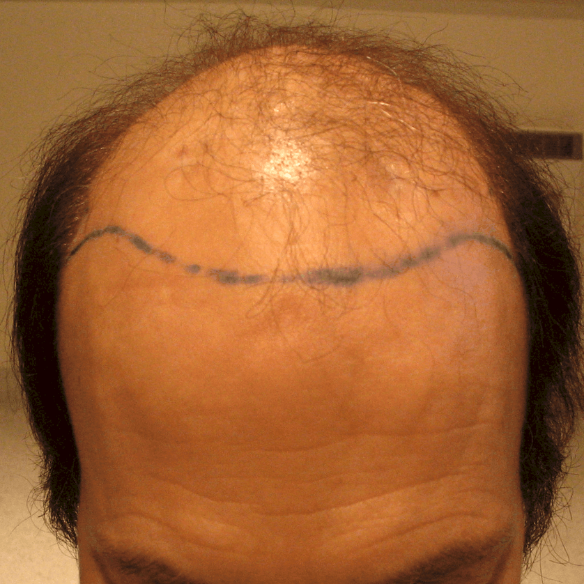 Completely Bald Hair Transplant: Can It Be Done? | Wimpole Clinic