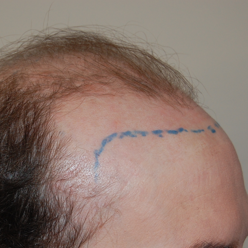 How Many Hair Grafts Do I Need? | Wimpole Clinic