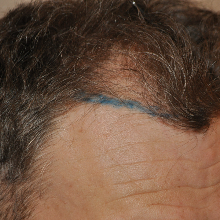 Norwood Stage 2: Photos, Treatments, Results | Wimpole Clinic