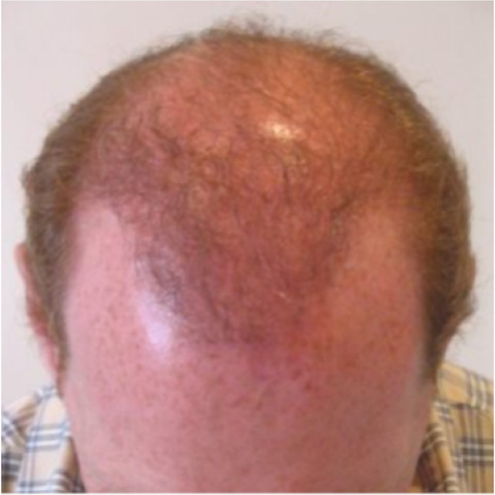 Norwood Scale: Causes, Stages & Treatments | Wimpole Clinic