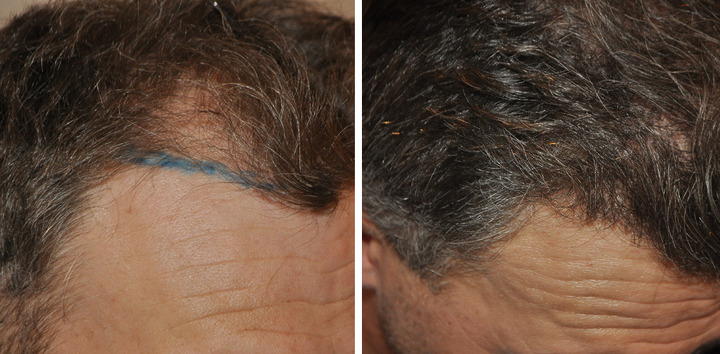 Norwood Stage 2: Photos, Treatments, Results | Wimpole Clinic