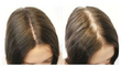 Normal Hair Parting Width vs Thinning: Causes and Treatments