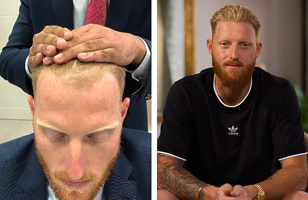 Justin Bieber Hair Loss: Everything You Need To Know