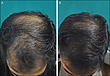 Botox For Hair: Do Botox Scalp Injections Promote Hair Growth?