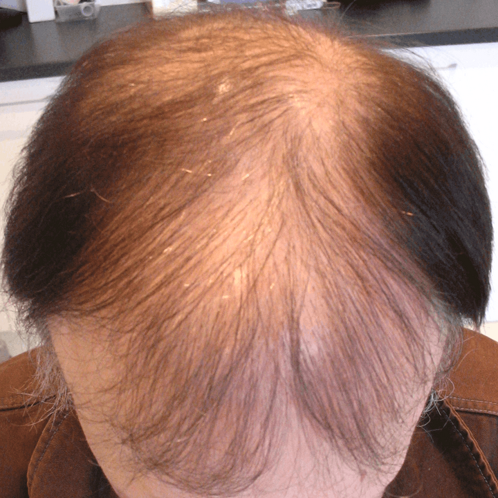 Norwood Scale: Causes, Stages & Treatments | Wimpole Clinic